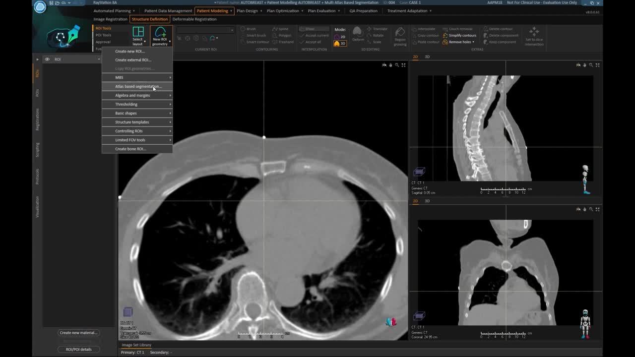 Patient Contouring and Plan Evaluation in RayStation | RaySearch ...